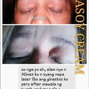 Syringoma | Skincare | Syringoma Cream Remove Syringoma 0 Effective ...